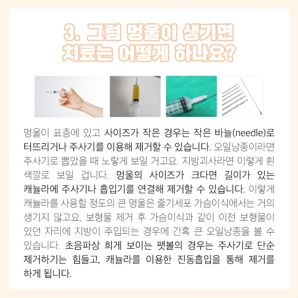 부작용에 대해 할말있다[멍울편] > 미다스칼럼 | 미다스성형외과 줄기세포가슴성형